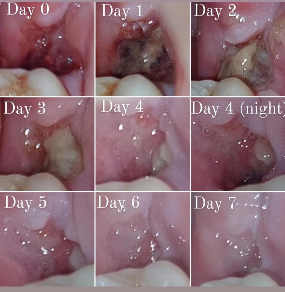 Healing Timeline After Tooth Extraction Healing Timeline After Tooth Extraction